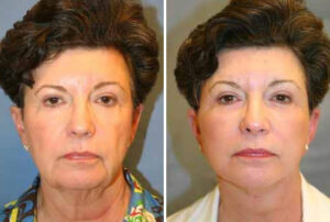 Facelift Surgery in Orlando | Hillcrest Plastic Surgery