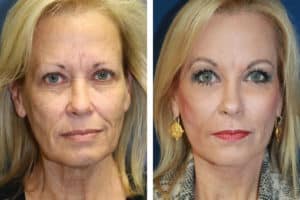 Facelift Surgery in Orlando | Hillcrest Plastic Surgery